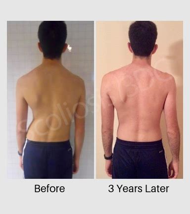 Scoliosis Before And After Yoga