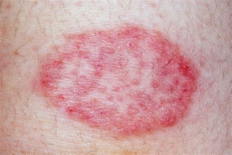 13 Causas de las manchas rojas rosadas o marrones en la piel según
