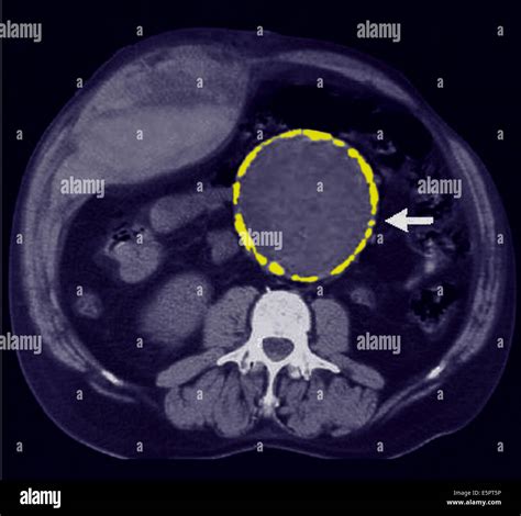 Abdominal Aortic Aneurysm Tomography Hi Res Stock Photography And