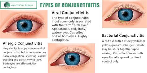 Allergic Conjunctivitis Vs Bacterial Conjunctivitis
