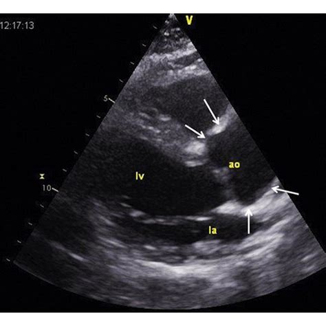 Echocardiographic Parasternal Long Axis View Showing The Ectatic