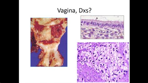 Pathology Of The Vulva Vagina And Uterus Flashcards Quizlet