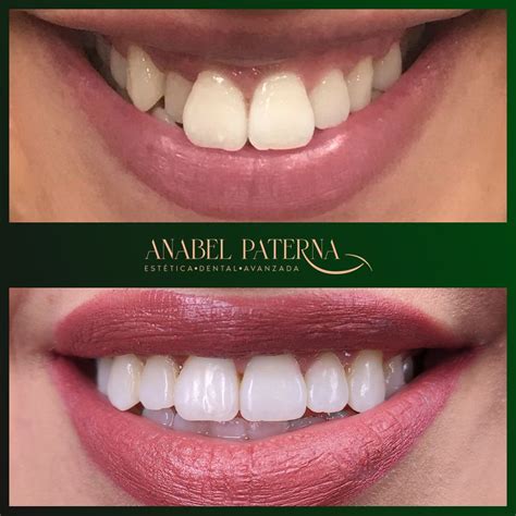 Antes y después Ortodoncia Anabel Paterna Clínica Dental