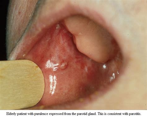 Swollen Parotid Gland Duct
