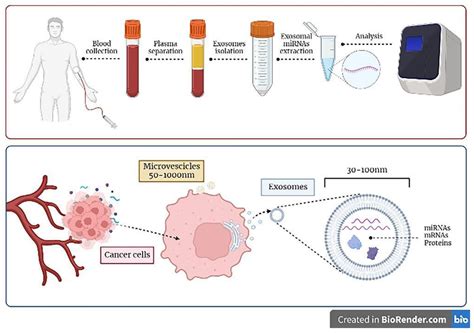 Exosome Based Liquid Biopsy Approaches In Bone And Soft Tissue Sarcomas