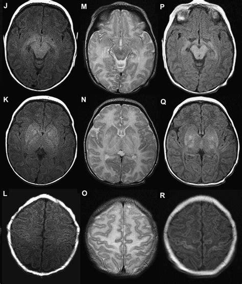Diffusion Weighted Imaging In Neonates Radiology Key