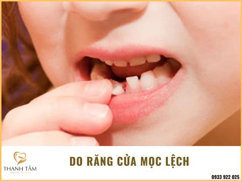 Cứ 10 Trẻ Chưa Rụng Răng Sữa Đã Mọc Răng Mới Răng Sữa Bé Chưa Rụng Mà