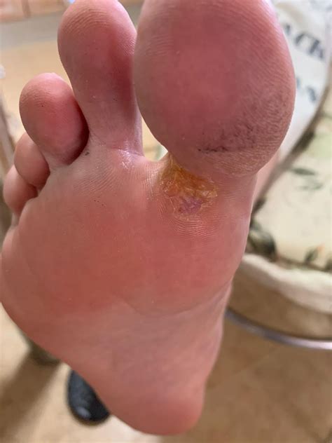 Ampollas en los pies durante el Camino de Santiago Cómo curarlas