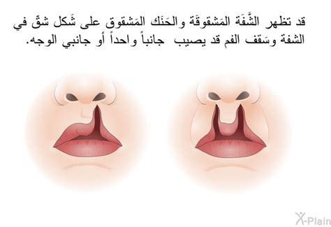 PatEdu الشفة المشقوقة والحنك المشقوق