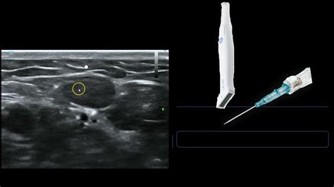 Ultrasound Guided IV Access YouTube