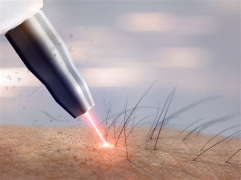 Depila O A Laser Perianal D I Conhe A Esse Procedimento