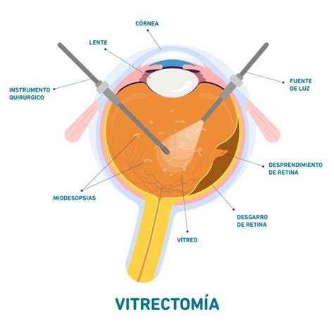 Cirugía de retina o Vitrectomía Cómo es salauno