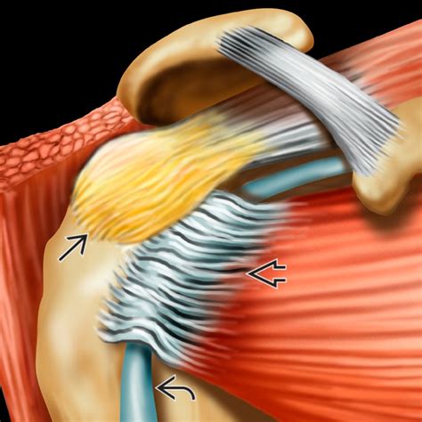 Rotator Cuff Biceps Tendinosis Radiology Key