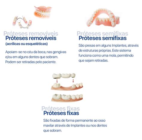 Pr Teses Dent Rias Tudo Sobre Higieniza O E Cuidados