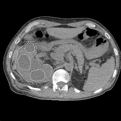 Pin On Urogenital Radiology