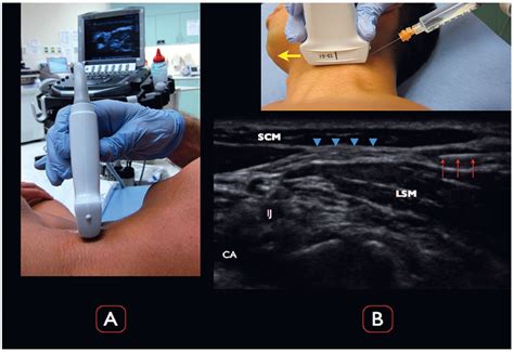 Pain Control Using Ultrasound Guided Superficial Cervical Plexus Block