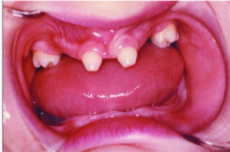 Den Abnormalities Of Teeth Ii Flashcards Quizlet