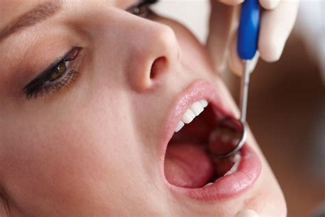 Candidiasis oral Síntomas y tratamientos Clínica Soto Vinaroz