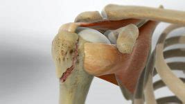 Fractura de Troquíter Dolor tratamiento y tiempo de recuperación JL