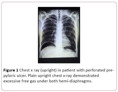 Duodenal Ulcer X Ray