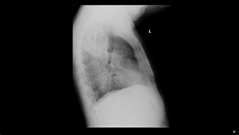 Imaging Case Of The Week Emergucate