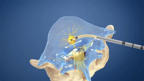Intracept Procedure For Chronic Low Back Pain Cantor Spine Institute