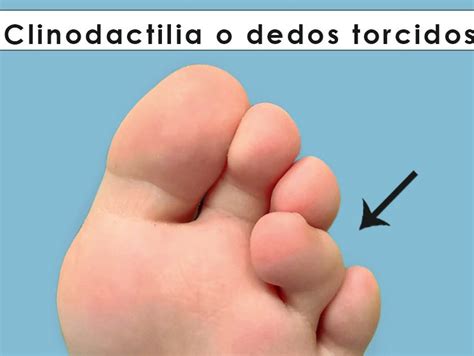 Qué es la sindactilia Centro Podológico Goitia