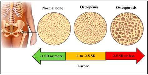 Osteomalacia Vs Osteoporosis