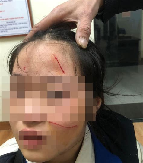 Vụ nữ sinh lớp 6 bị bạn đánh rách mặt ở Hà Nội vì chuyện tình cảm Đã