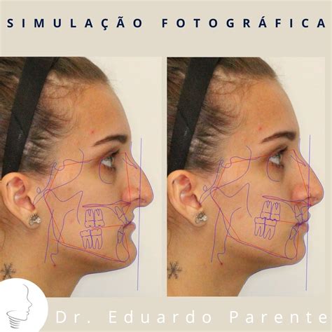 Cirurgia Ortogn Tica Dr Eduardo Parente