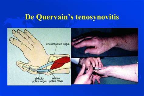 PPT De Quervain S Tenosynovitis Digital Flexor Tenosynovitis