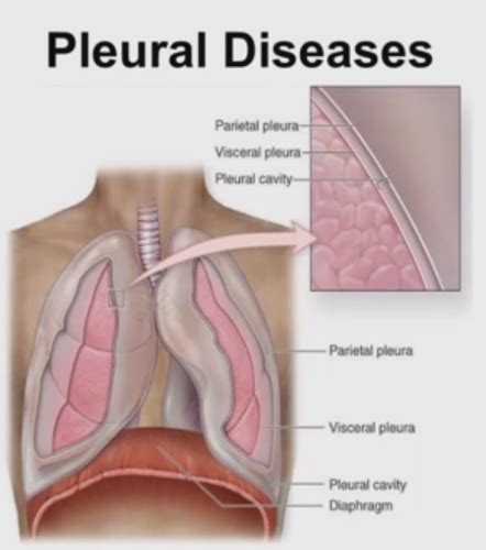 Pleural Disease Flashcards Quizlet