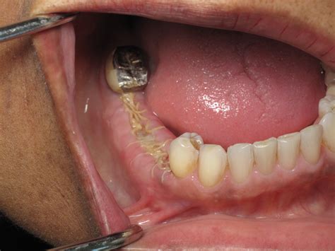 Dental Bone Healing At Steven Schutz Blog
