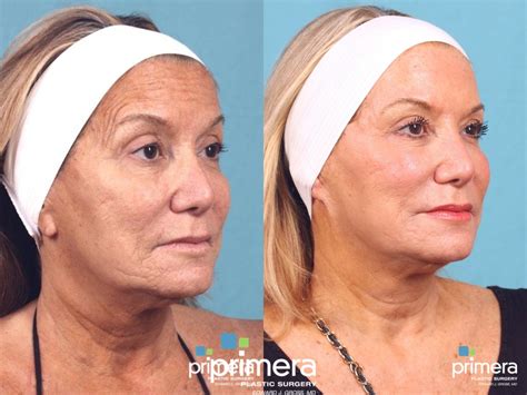 Laser Skin Resurfacing Dot Co Before And After Pictures Case