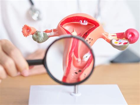 O que é mioma uterino Pode mesmo evoluir para câncer ou causar