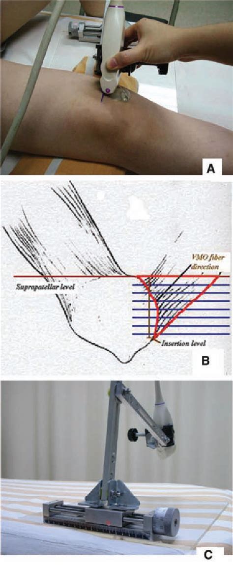 Figure 1 From Differences In Sonographic Characteristics Of The Vastus