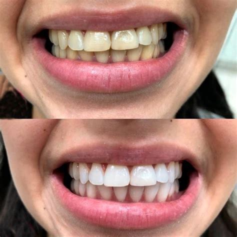 Clareamento Dental Só Sorriso Odontologia Recreio do Bandeirantes