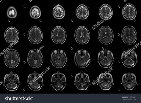 Human Brain On Mri Scans Transverse Sectional Planes Of The Human Head