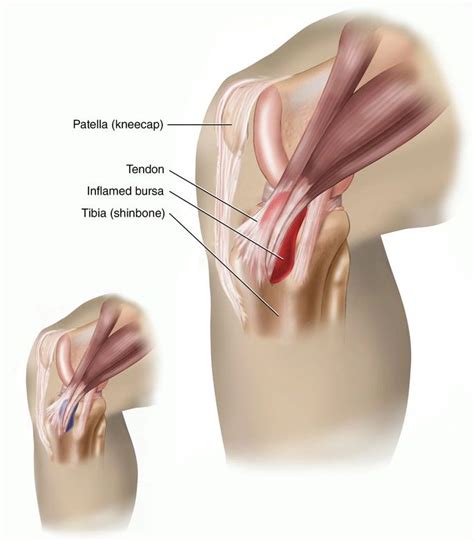 Pes Anserine Bursa Injection