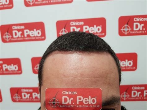 Injerto Cirugia Capilar Dr Pelo Sevilla Badajoz Madrid Cordoba