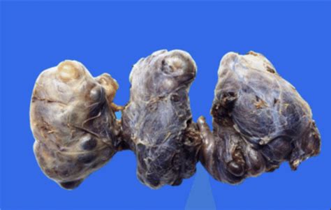 A Nodular Hyperplasia Nodular Or Multinodular Goiter A Gross