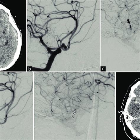 A Head Computed Tomography Scan Demonstrates Subarachnoid Hemorrhage