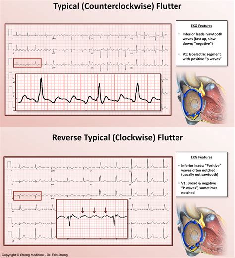 Atrial Flutter Litfl Ecg Library Diagnosis