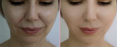 Before And After Facelift To Improve Nasolabial Folds Sm Stock Photo