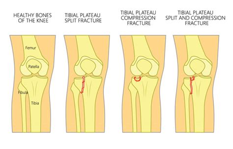 Knee Fractures Fernando Bidino
