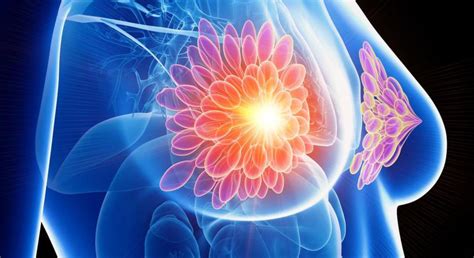 Détecter un cancer du sein 5 ans avant les symptômes cest déjà