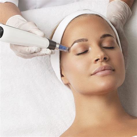 Beneficios Del Microneedling Con Plasma Rico En Plaquetas ACEE