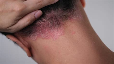 Vous devez essayer ces méthodes naturelles pour soigner le psoriasis
