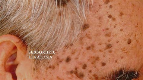What Is Seborrheic Keratosis Age Spots Sun Spot Remover