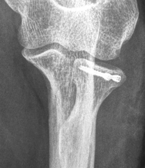 Fracture du coude Clinique Ostéo Articulaire des Cèdres Grenoble